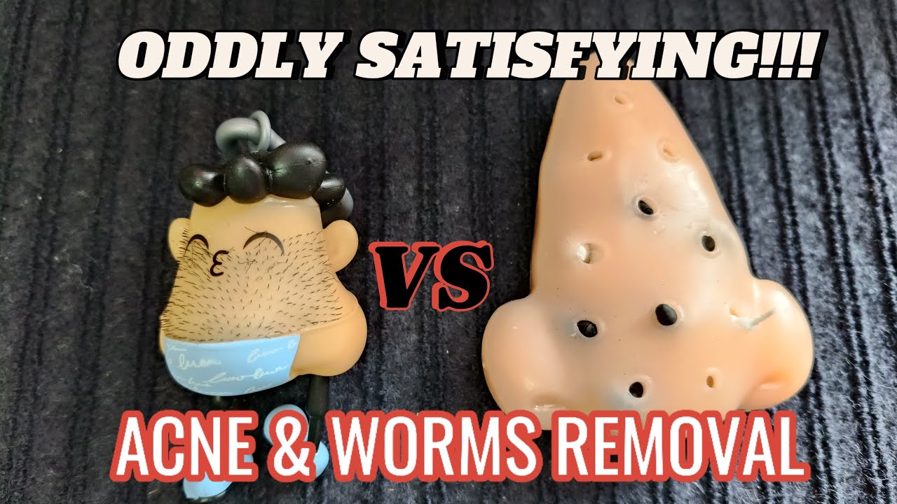 😳 STRESS RELIEF!!! ODDLY SATISFYING THING TO DO 😳 ACNE & WORMS REMOVAL ...