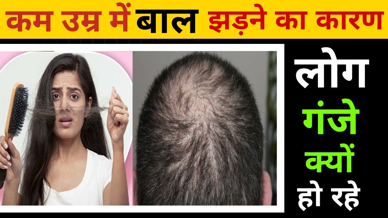 कम उम्र में बाल गिरने का कारण Hairfall Treatment Bal Jhadne Ka