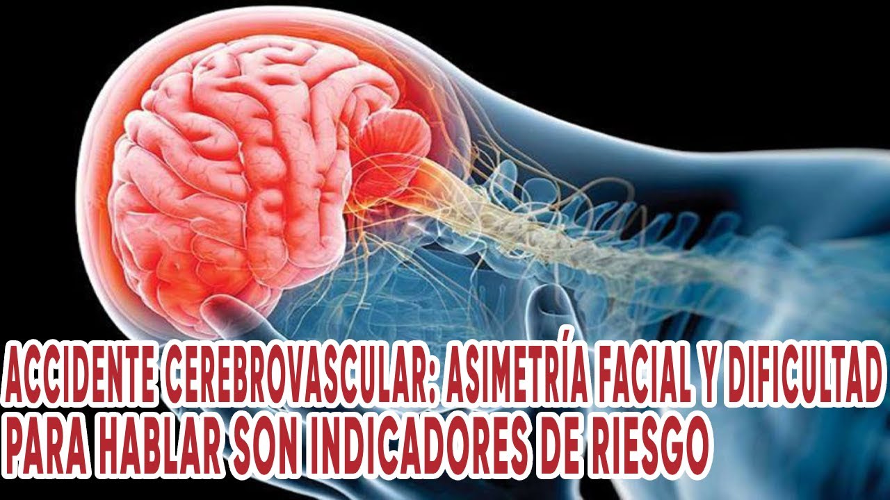 ACV: asimetría facial, dificultad para hablar son indicadores de riesgo - YouTube