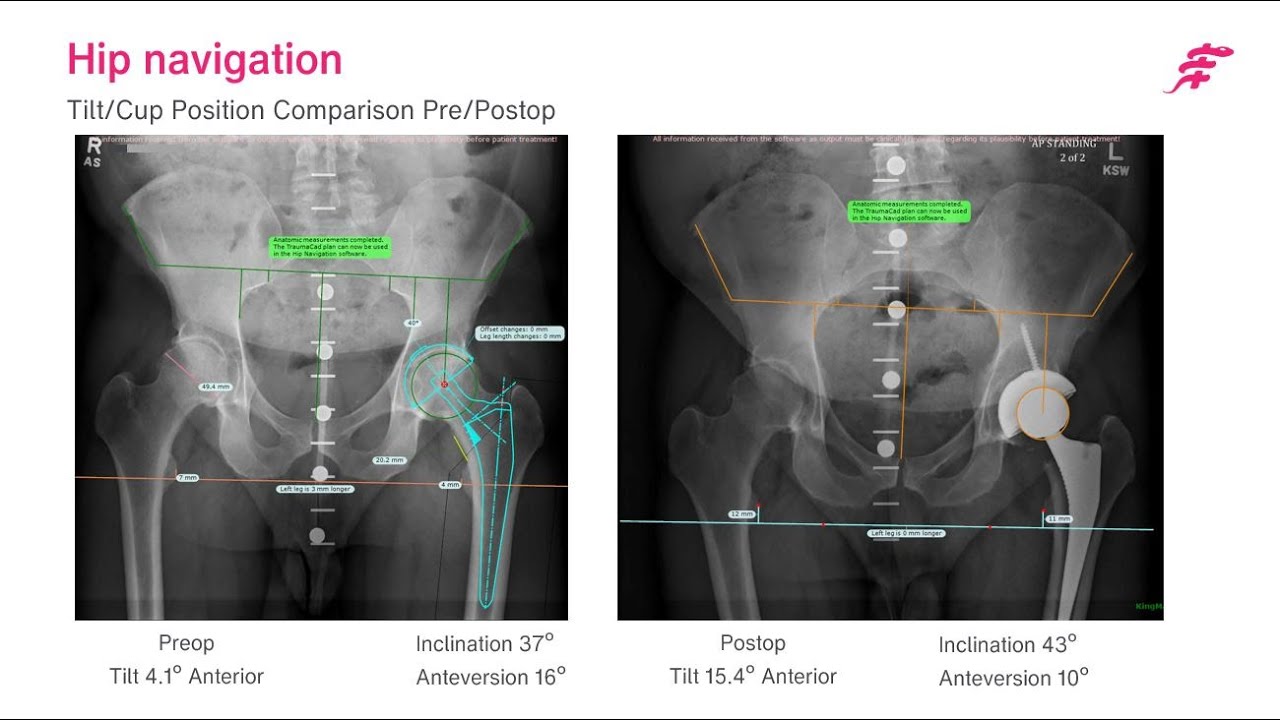Webinar: TraumaCad Advanced Measurement Tools in Orthopedic Planning ...
