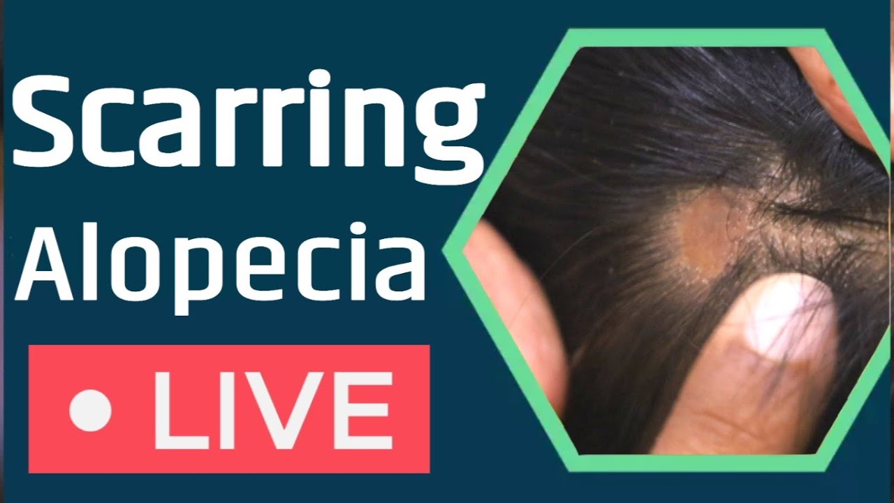 What is Scarring Alopecia? Solution Of Scarring Alopecia!6 - YouTube