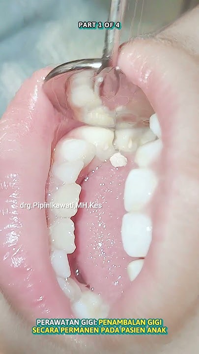 PENAMBALAN GIGI SECARA PERMANEN PADA PASIEN ANAK || PART 1 OF 4 - YouTube