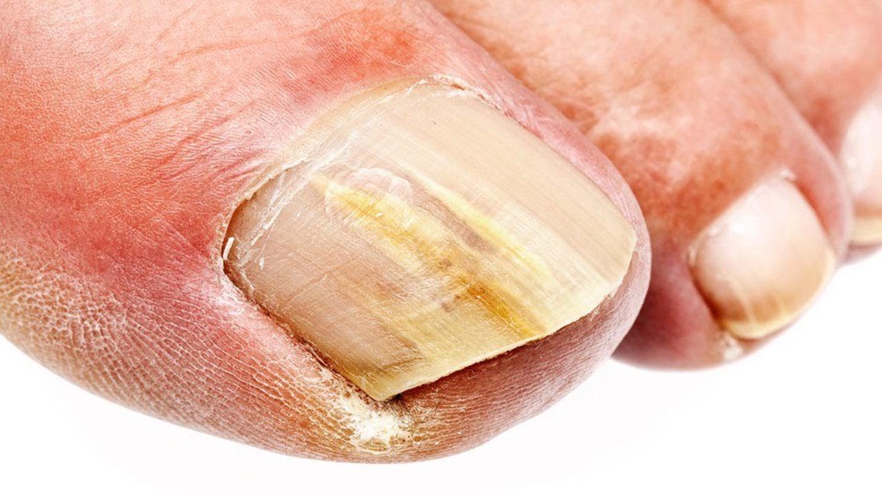 Summer Crusty Nails and Calluses - and Music - YouTube