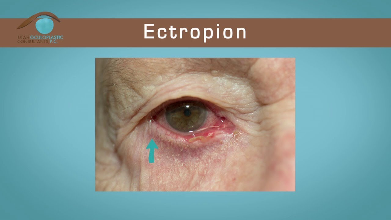 Ectropion Or Entropion