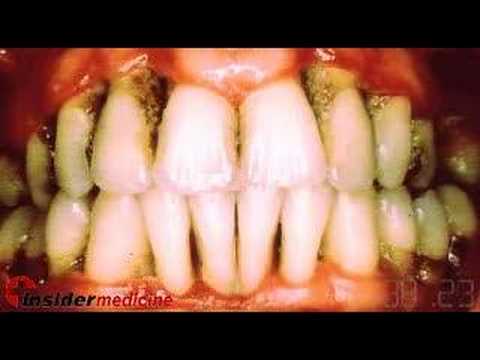 Cannabis use linked to gum disease - IN60