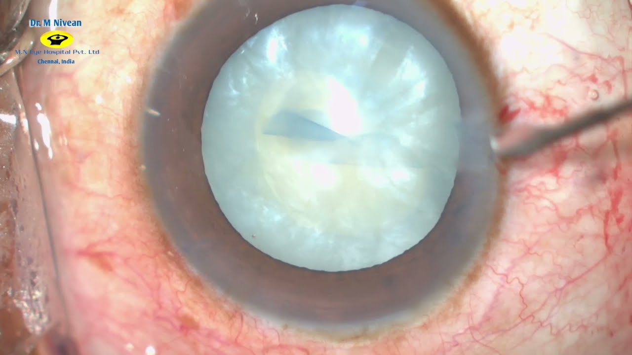 NvN Phacoemulsification in Mature Intumescent Cataract using Modified ...