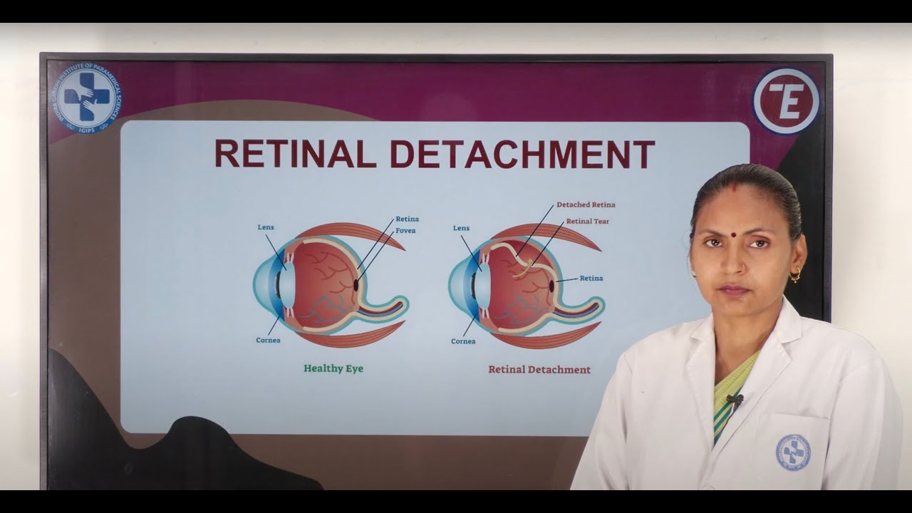Retinal Detachment | रेटिनल डिटेचमेंट | Types, Causes, Symptoms ...