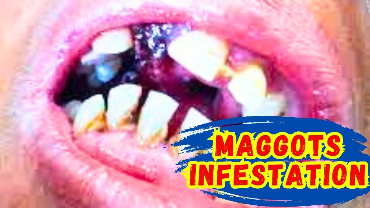 This Isn't a Toothache. Maggots Infestation.🦷 | Shocking Truth About ...