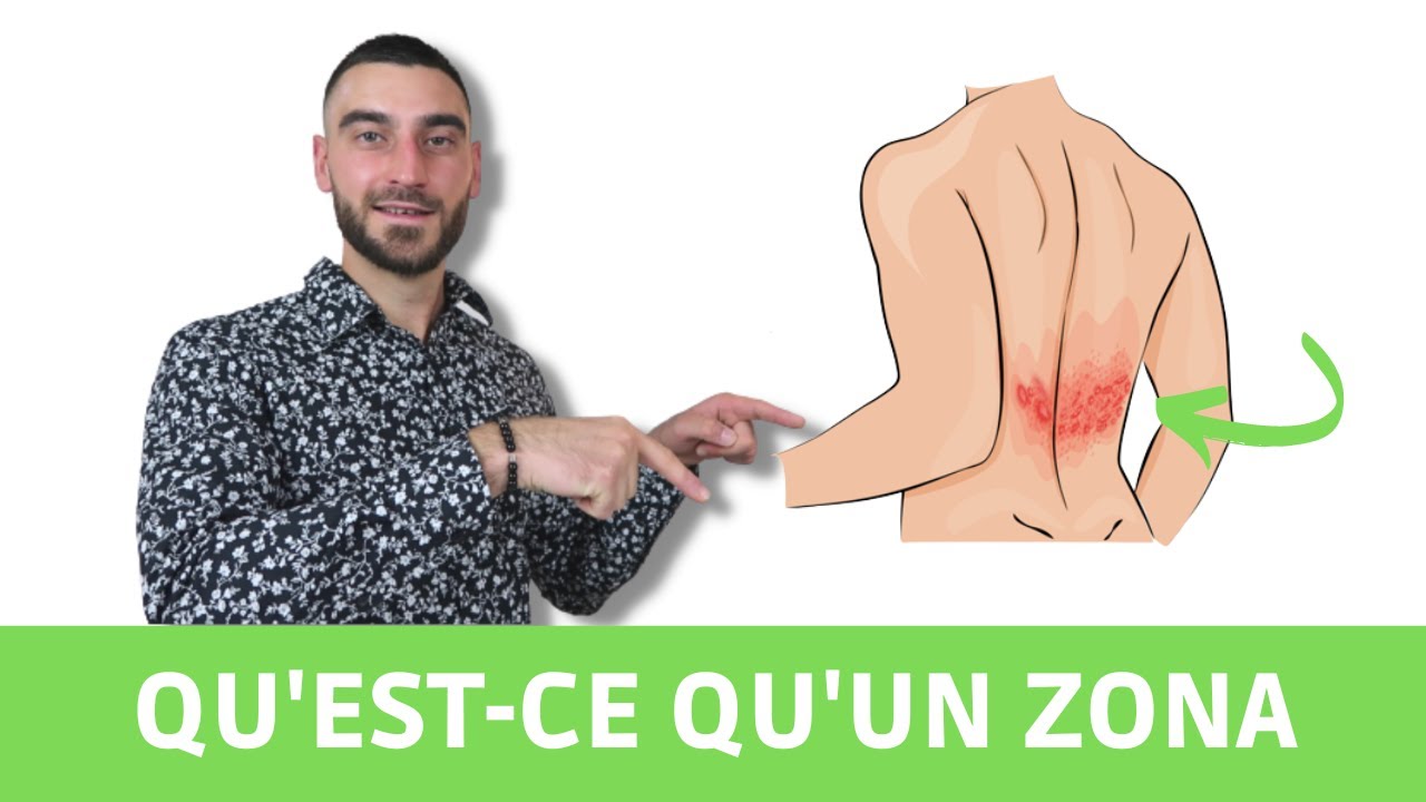 Qu'est-ce qu'un zona - YouTube