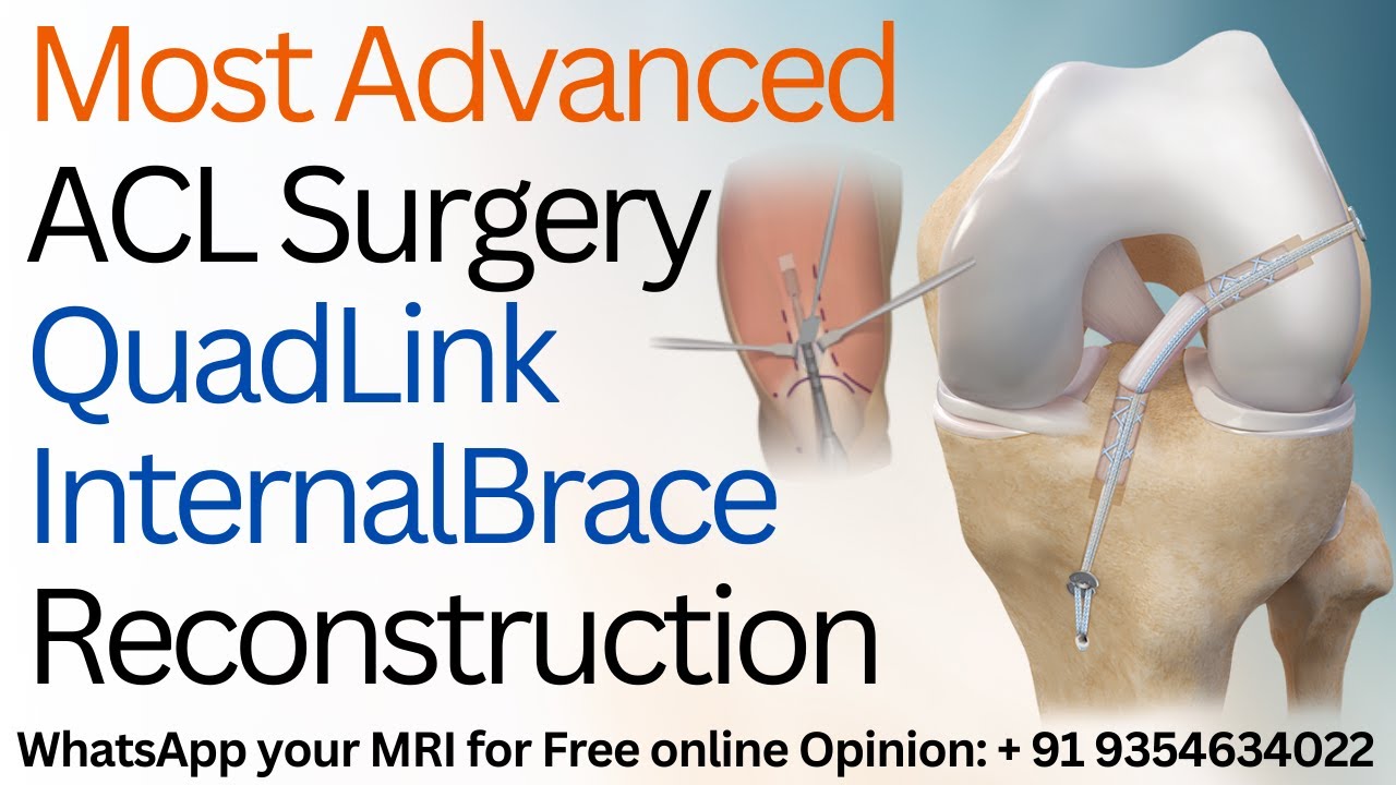 सबसे आधुनिक ACL लिगामेंट सर्जरी Most Advanced ACL Surgery - QuadLink ...