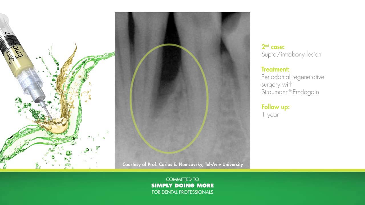 Straumann Emdogain - YouTube