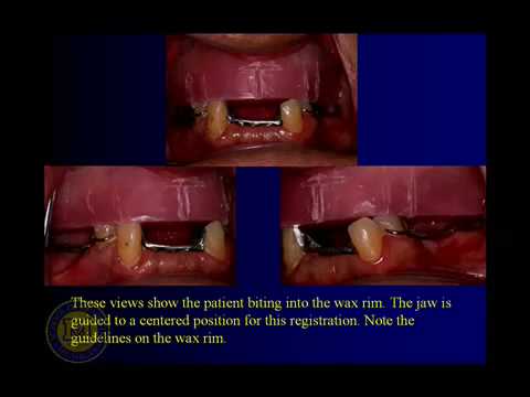 DENT 718: Combination cases: complete and partial denture sets - YouTube