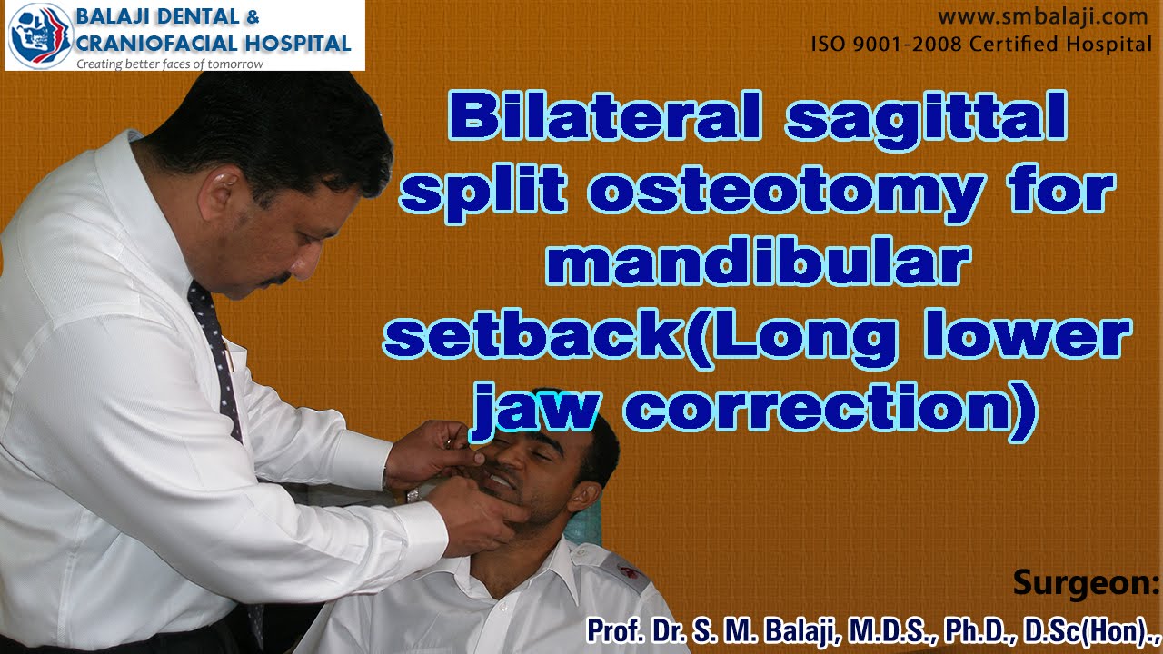 Bilateral sagittal split osteotomy for mandibular setback (Long lower ...