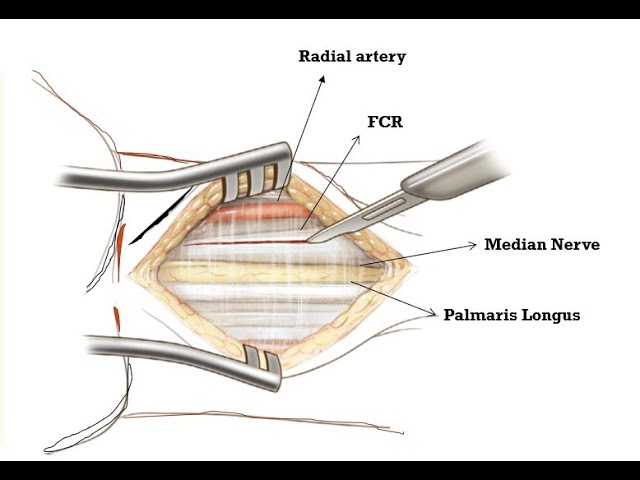 Volar Approach To Radius