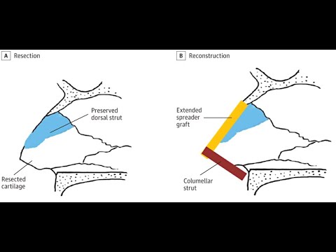 Modified Anterior Nasal Septal Transplant Technique - YouTube