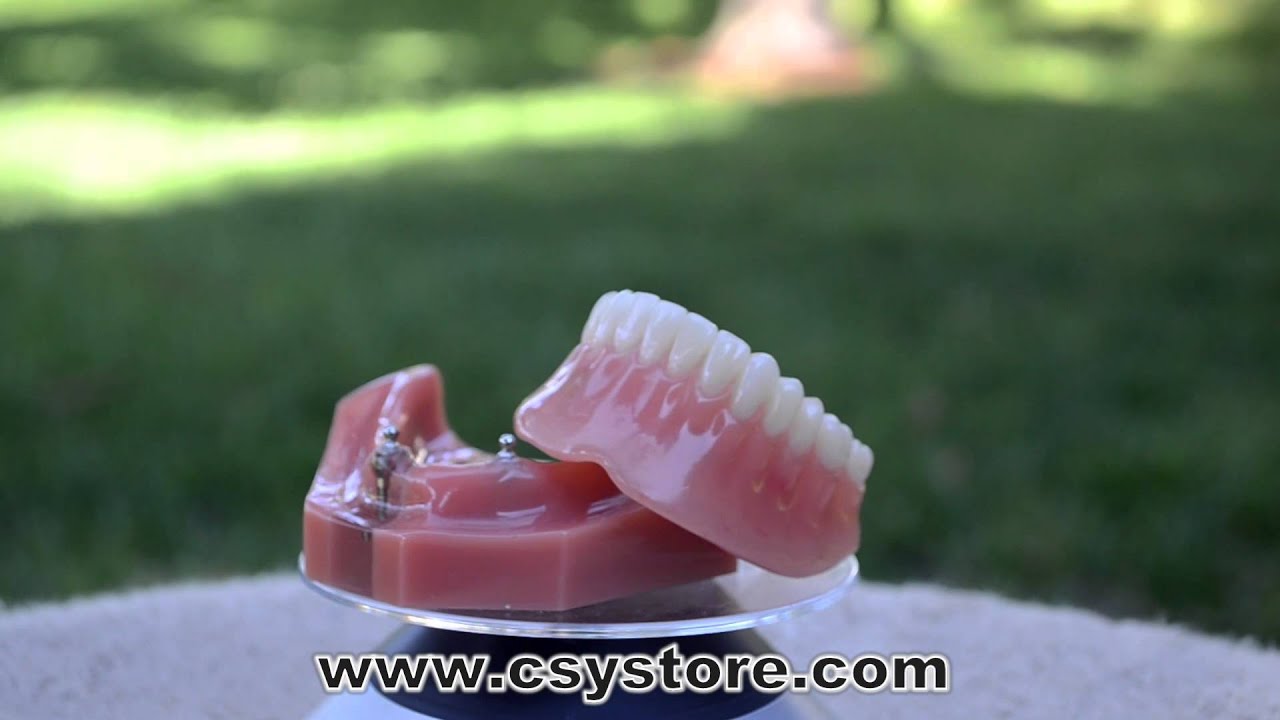 600701 Overdenture Inferior with 2 Implant - YouTube