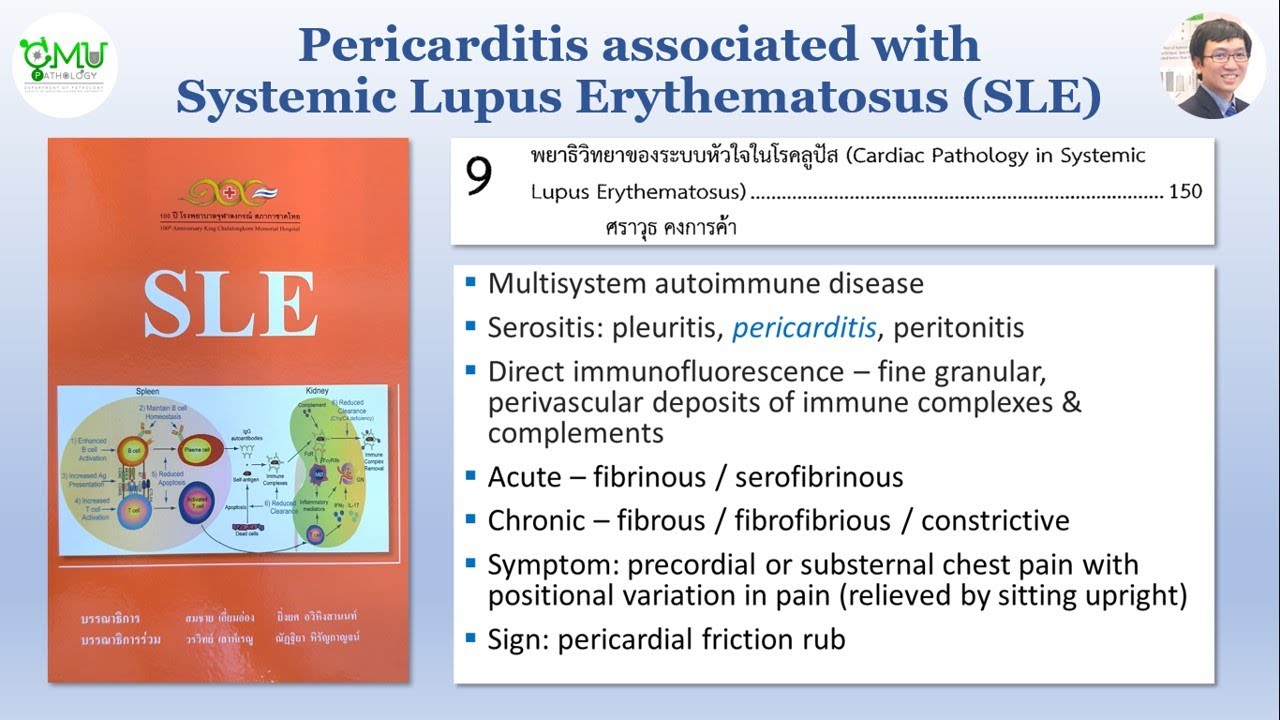Patho Minutes: Pericarditis associated with SLE - YouTube