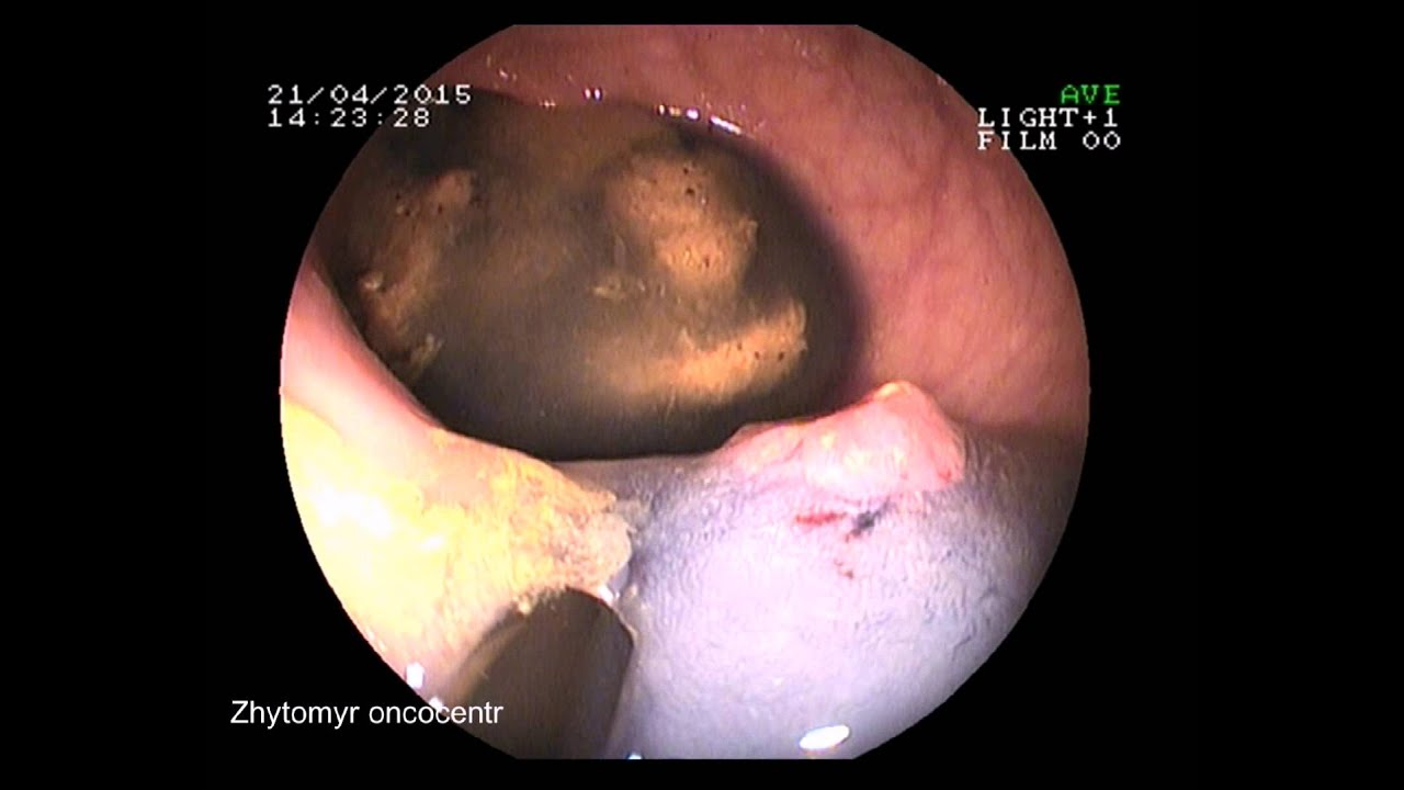 Endoscopy mucosal resection (EMR) early colon cancer (0-Is) - YouTube