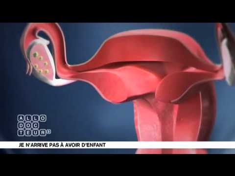 Infertilité féminine - de la stimulation à la fécondation - YouTube