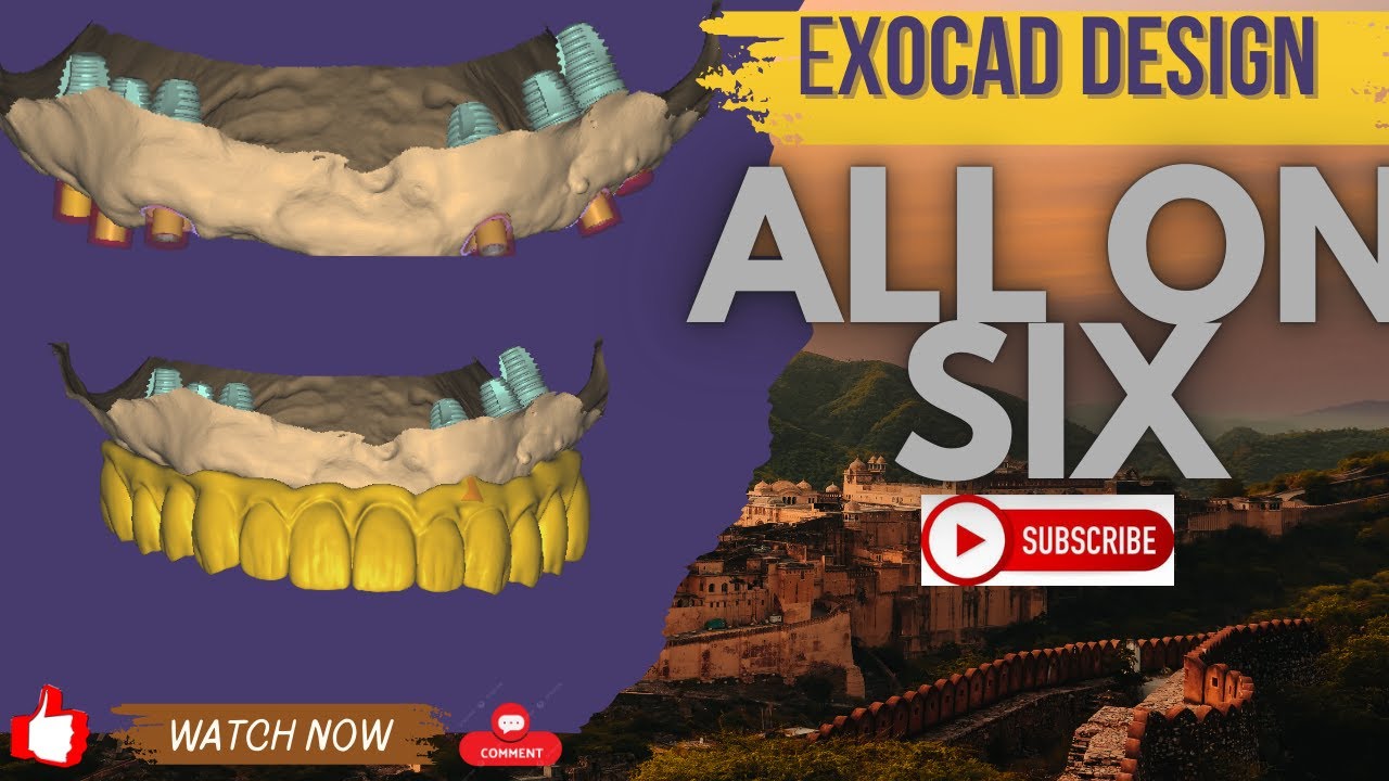 EXOCAD TUTORIAL : HOW TO DESIGN ALL ON SIX IMPLANT WITH ACCESS HOLE ...