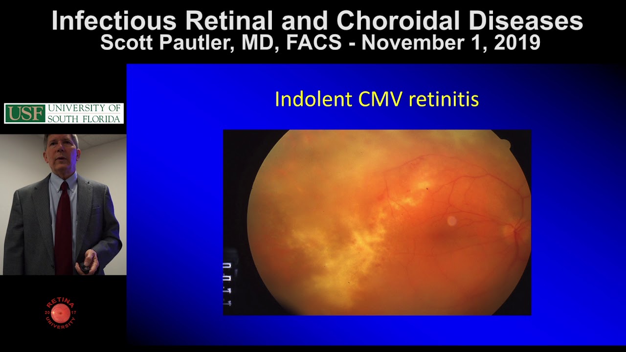 Infectious Retinal and Choroidal Inflammatory Diseases - YouTube