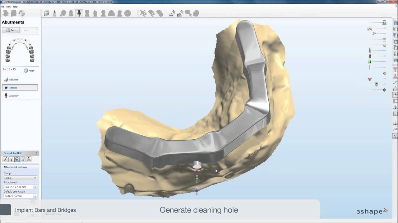 TEAMZIEREIS - 3shape Implant Bars and Bridges.wmv - YouTube