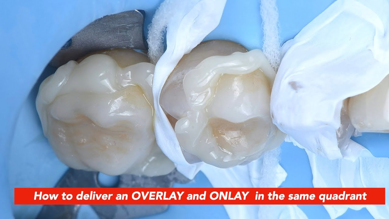 ONLAY AND OVERLAY IN THE SAME QUADRANT DELIVERED WITH HEATED COMPOSITE ...