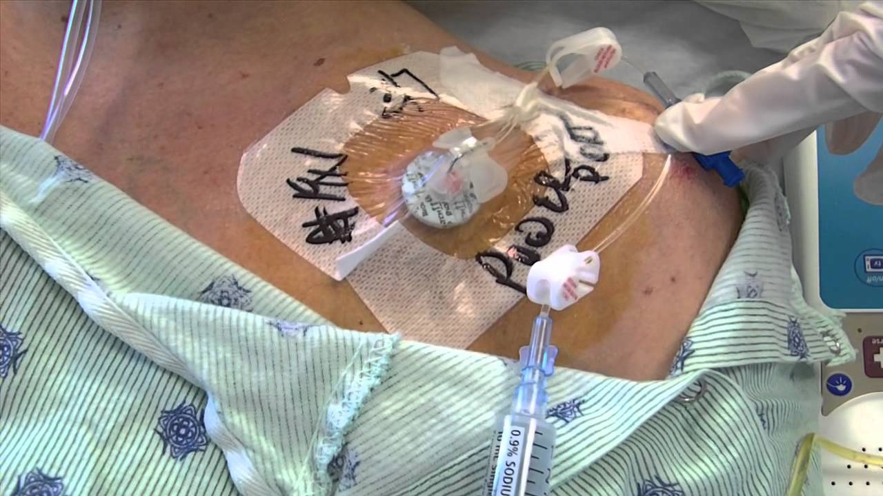 Implanted Port with possible POS (pinch-off syndrome) - YouTube