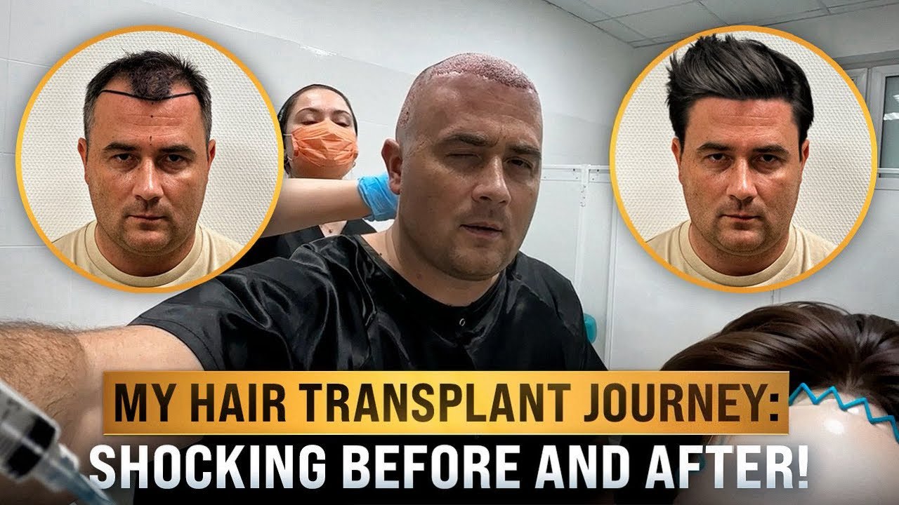 My Hair Transplant Journey: Shocking Before and After! - YouTube