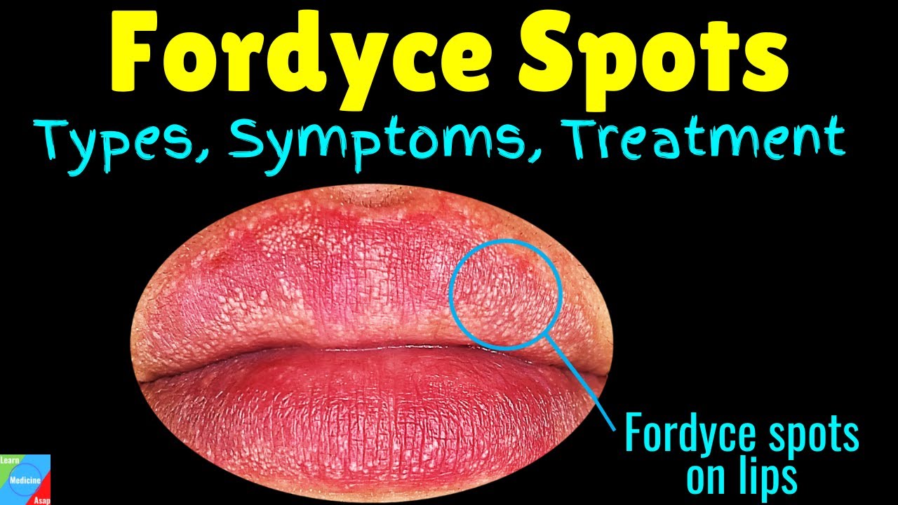 What Are Fordyce Spots On Lips Caused By - Infoupdate.org What Are Fordyce Spots On Lips Caused By - Infoupdate.org