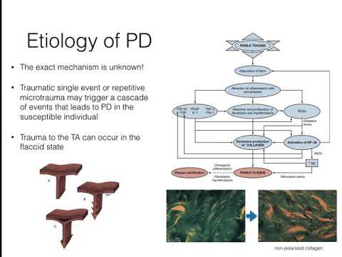 Peyronie's Disease: An Update to Clinical Practice Guidelines - YouTube