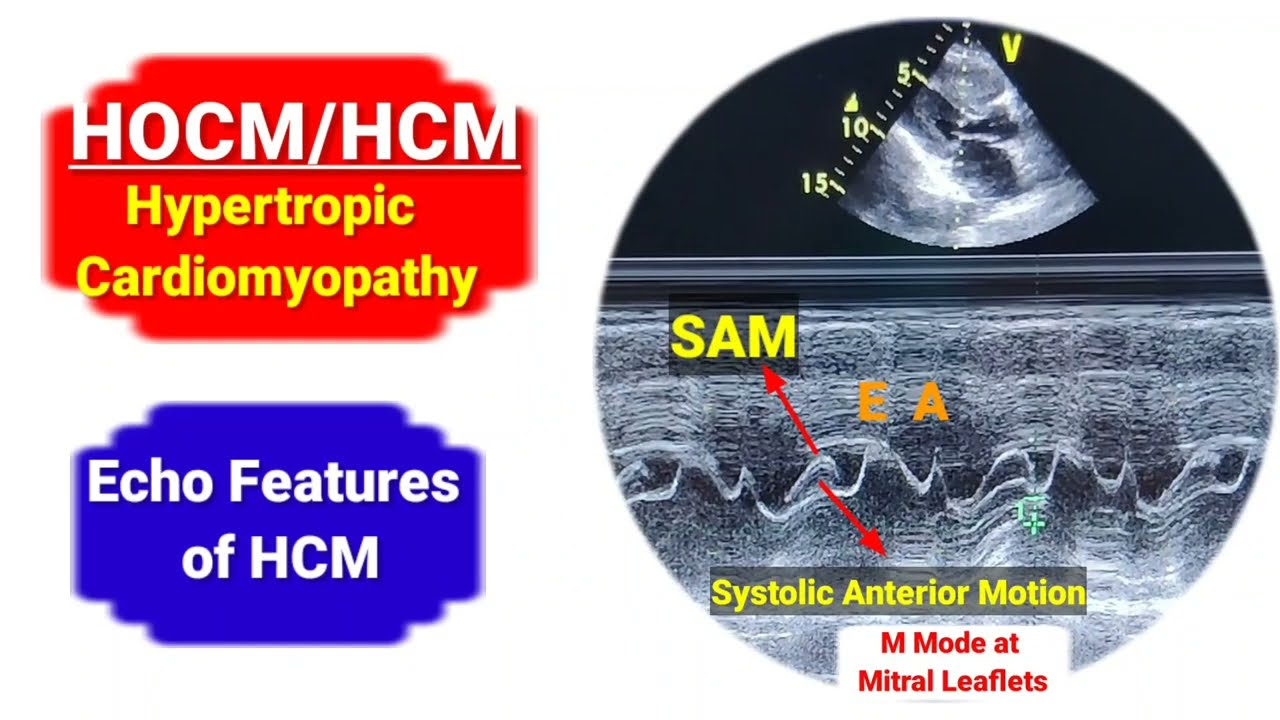 Echocardiogrphy of HCM/ Hypertropic Cardiomyopathy/ features of HCM in ...