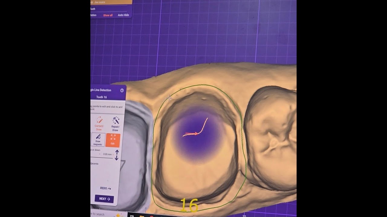 How to Design Dental Crowns in Exocad (Full Tutorial) - YouTube