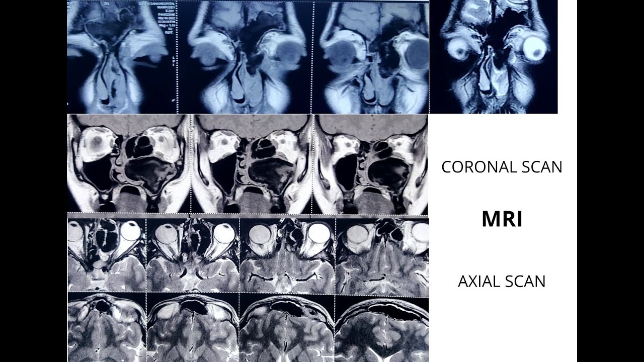 FESS and DRAF-2a via Carolyn's Window approach for extensive Allergic ...