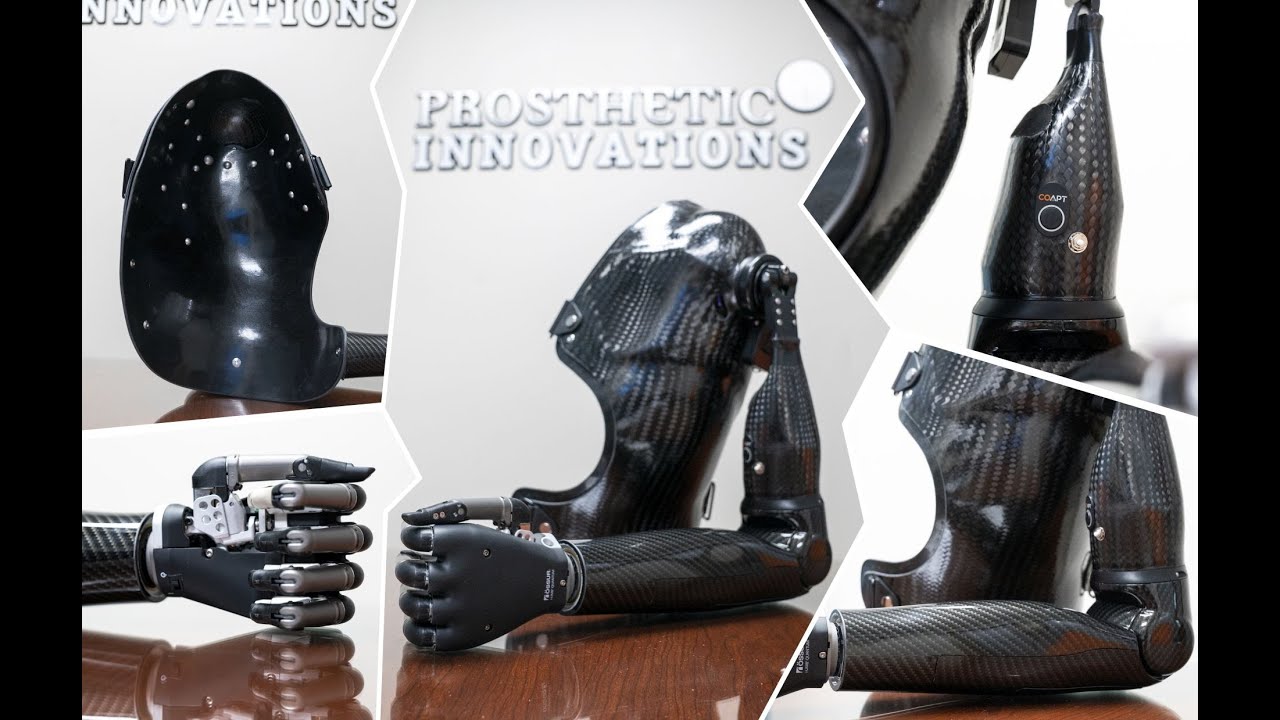 Shoulder Disarticulation Prosthesis | Prosthetic Innovations - YouTube