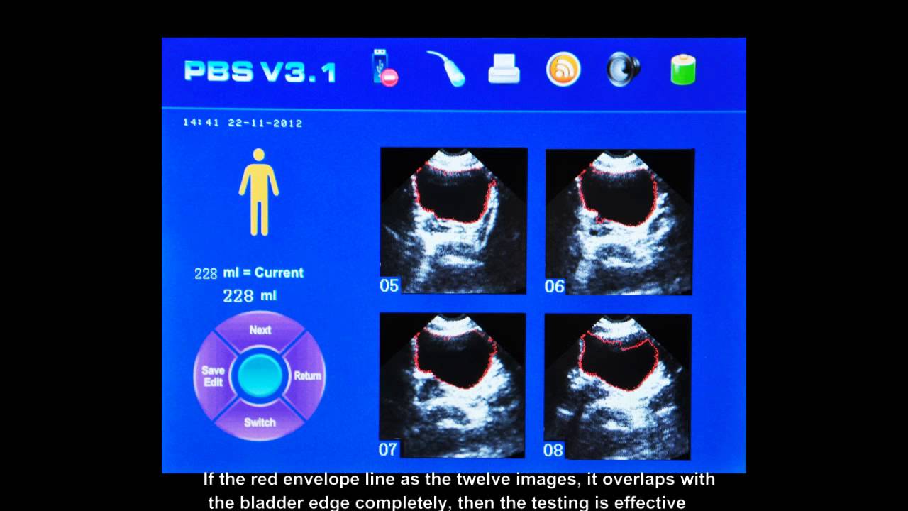 Bladder Scanner PBSV3.1-Mianyang Meike from China - YouTube