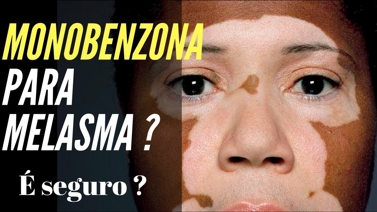 CLAREAMENTO DE PELE COM MONOBENZONA - HIDROQUINONA OU MONOBENZONA PARA ...