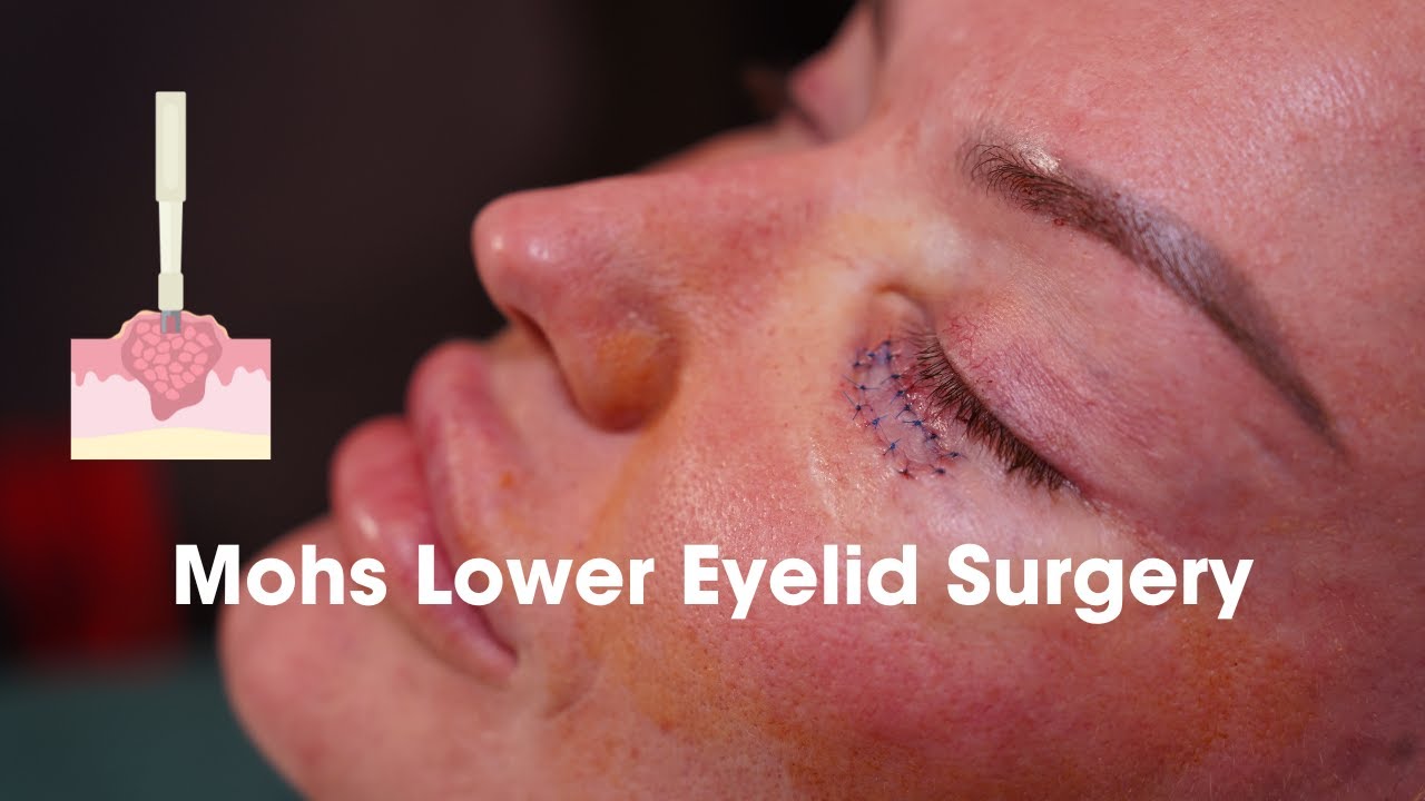 Mohs Lower Eyelid Surgery Youtube