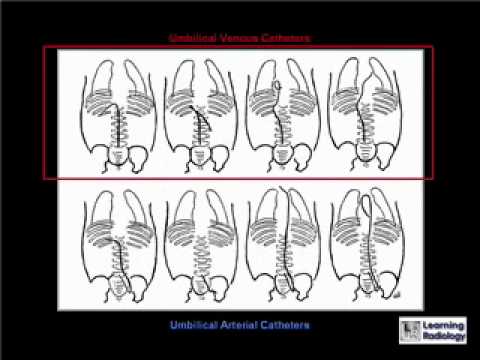 LearningRadiology 33 (Umbilical Catheters) - YouTube