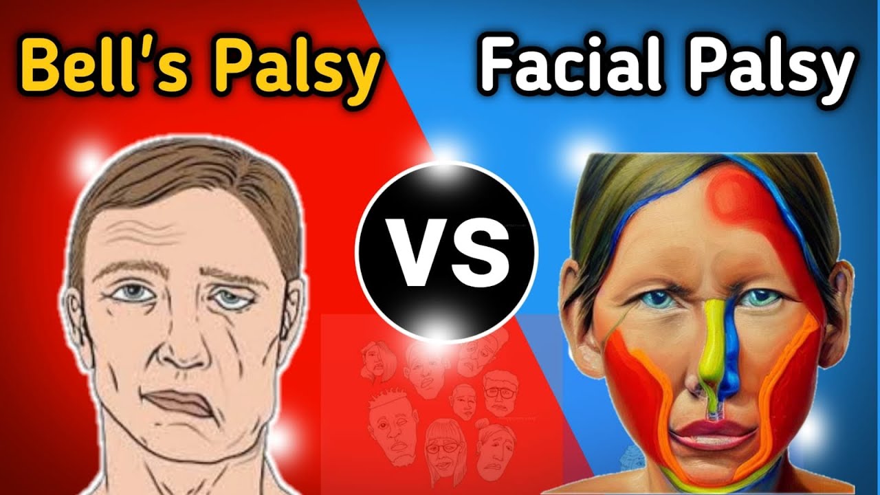 Bell’s palsy vs facial palsy | what is the difference between Bell’s ...