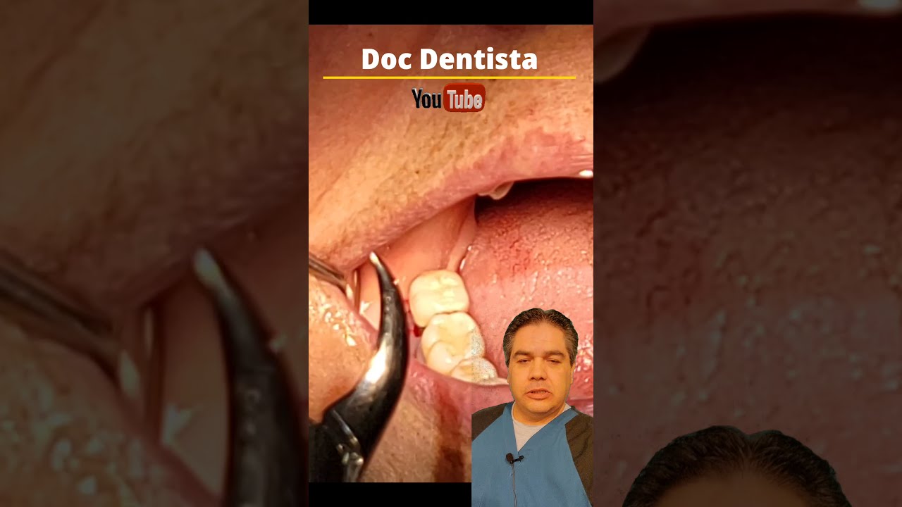 Extracción de muela 🦷 facil y rápido con mobilidad por pérdida de hueso ...