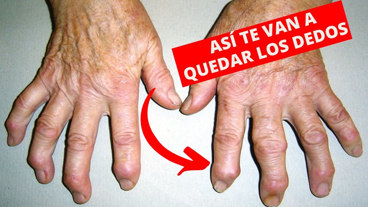Tronarse los dedos de la mano, ¿es malo ? | consecuencias de # ...