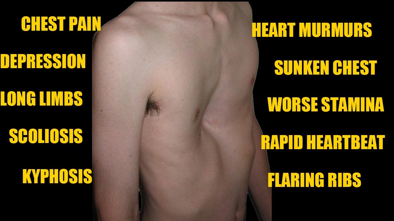 Symptoms of Pectus Excavatum & How To Fix Them - YouTube