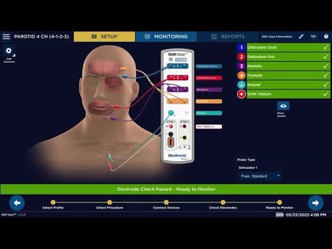 NIM Vital™ nerve monitoring system Set-up - Parotid procedure - YouTube