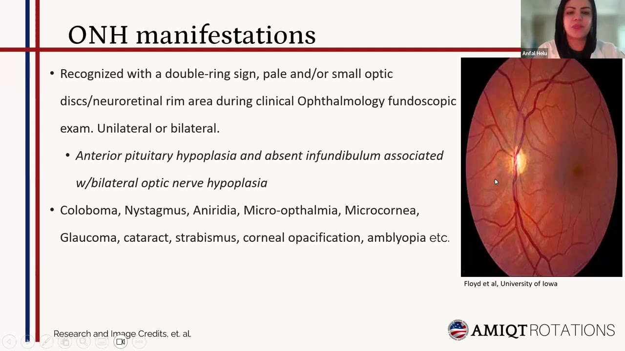 Optic Nerve Hypoplasia