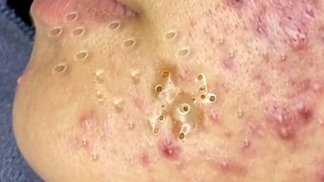 Up-Close Blackhead Extraction – So Satisfying to Watch! #33754 - YouTube