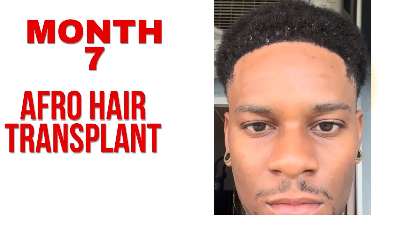 7 month Afro transplant update Part 2 - YouTube