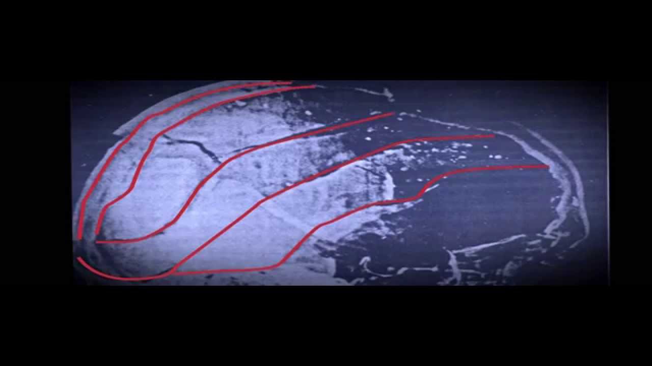 JFK Skull Fracture Analysis Cold Case - YouTube