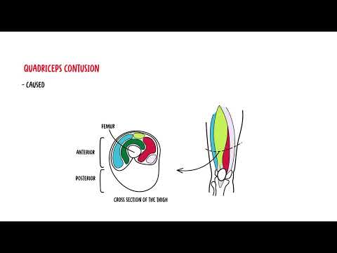 How To Treat A Bruised Quadricep