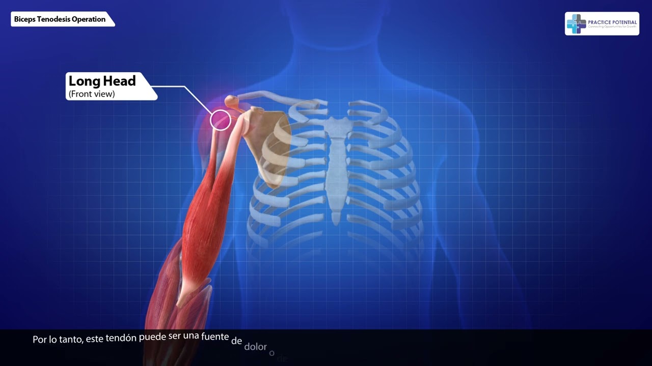 Tenodesis del Bíceps | Practice Potential - YouTube